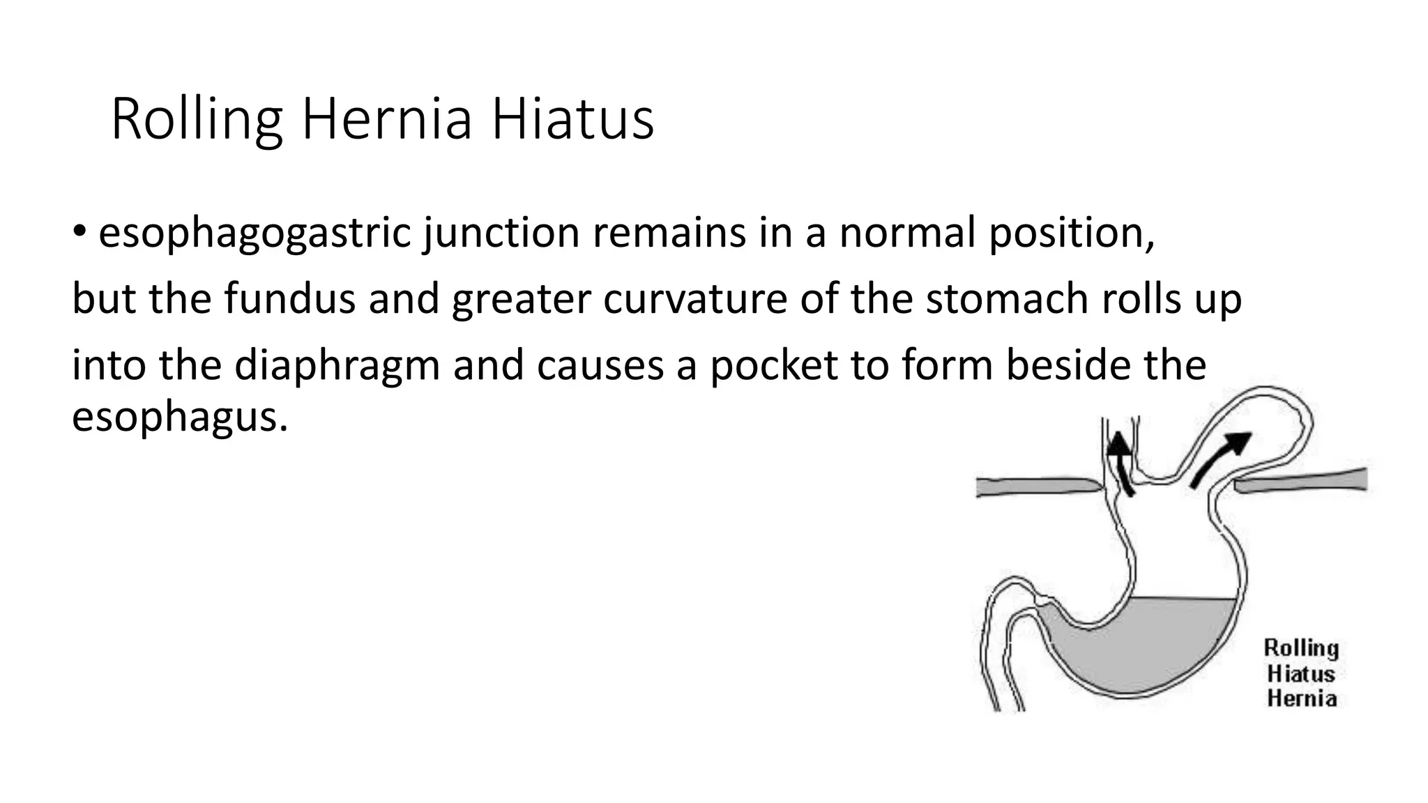 Hernia hiatus | PPTX