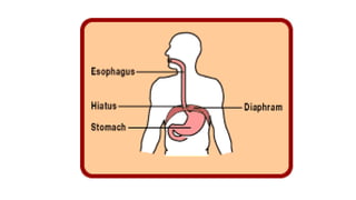 Hernia hiatus | PPTX