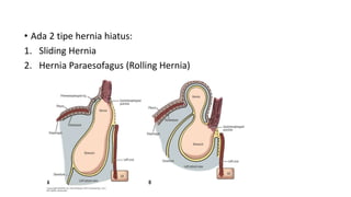Hernia hiatus | PPTX