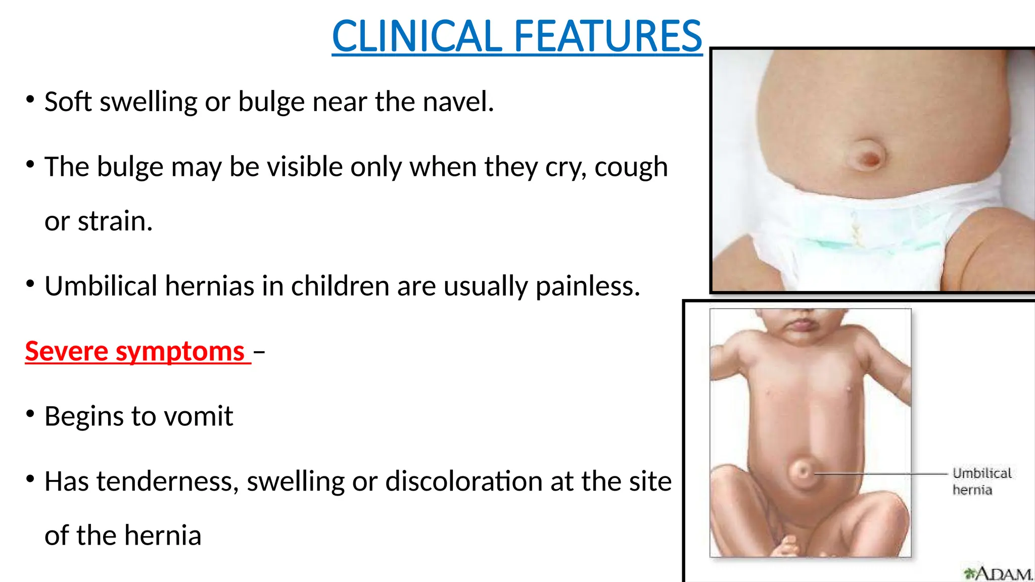 HERNIA in children/ pediatric hernias.pptx