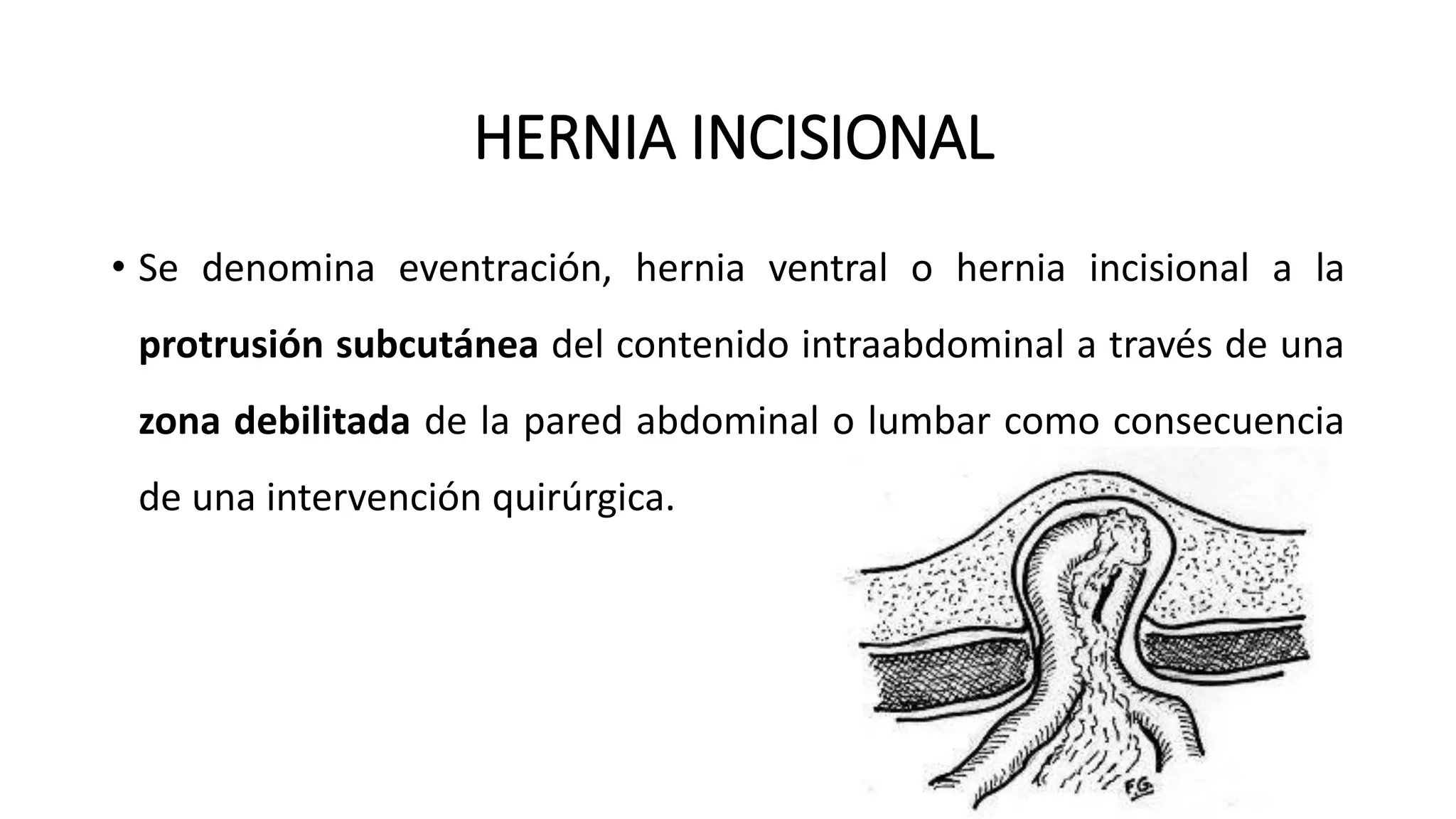 HERNIA INCISIONAL.pptx