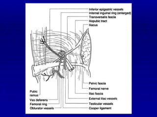 Hernia Inguinal | PPT