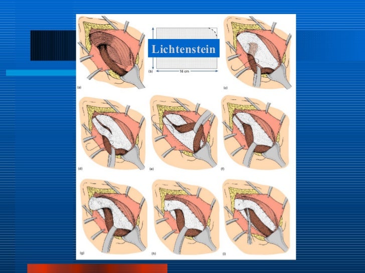 Hernia inguinais . dr. falcão