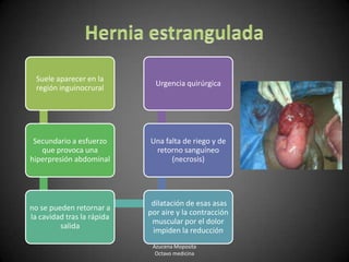 Hernia inguinal | PPTX