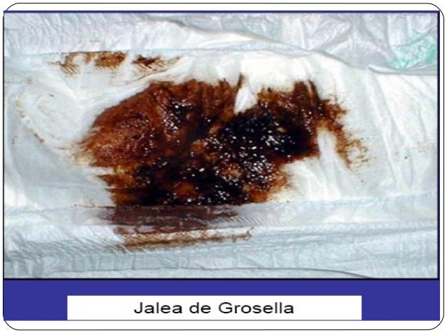 Abdomen agudo quirurgico en pediatria