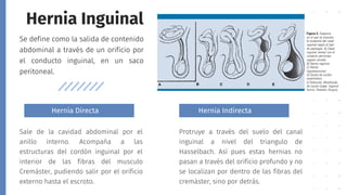 Hernia Inguinal.pdf