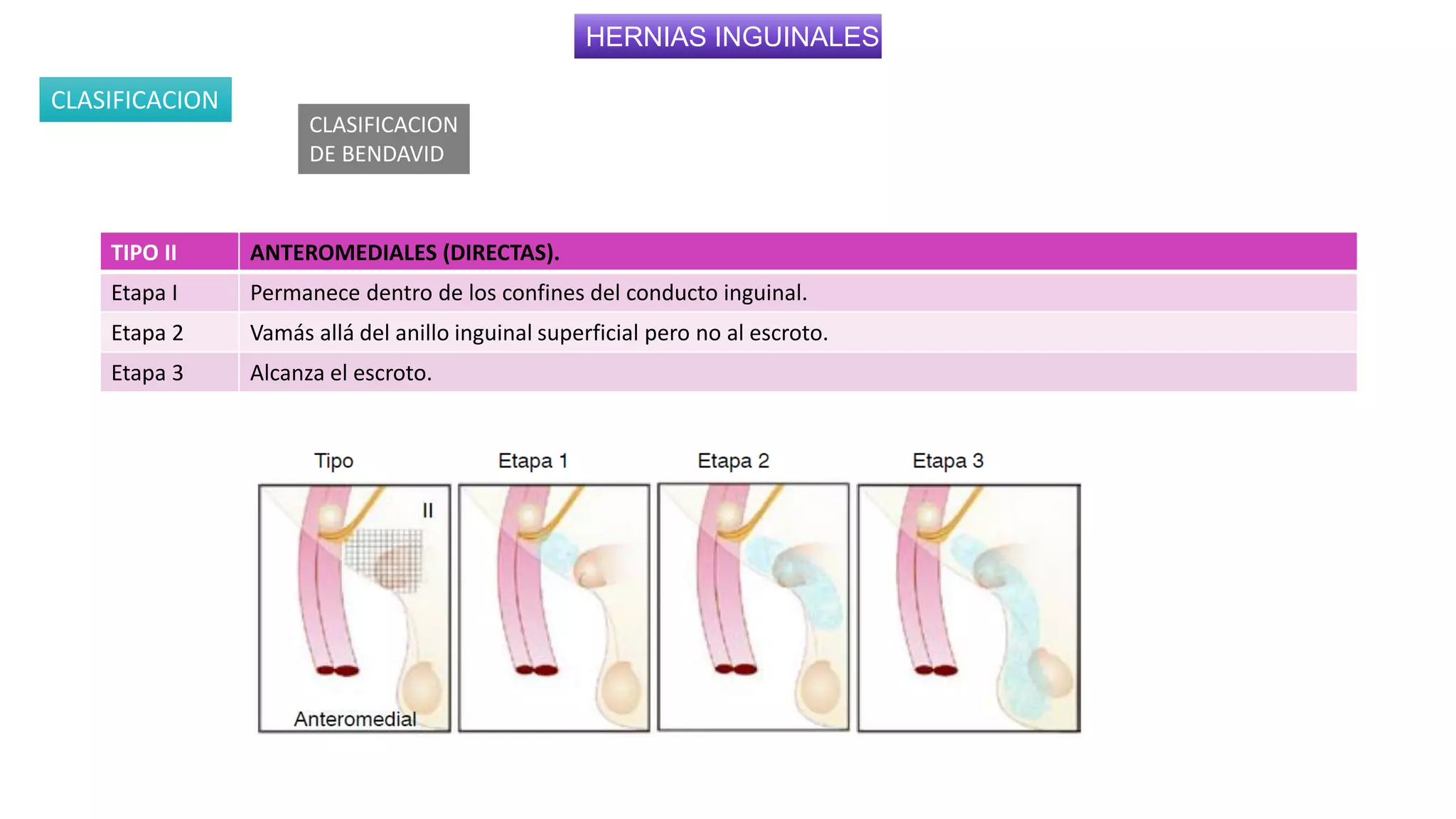 hernia inguinal.pptx