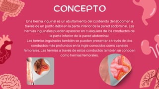 Hernia Inguinal.pdfffffffffffffffffffffffffff | PDF