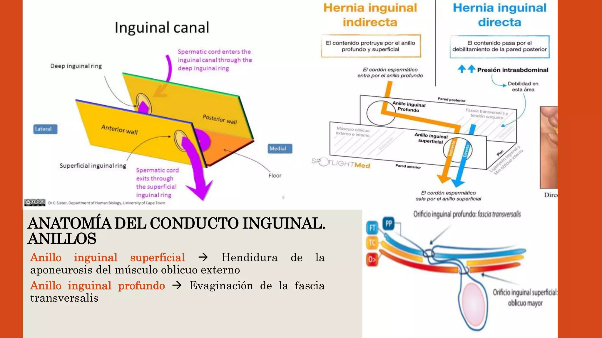 Hernia Inguinal | PPTX