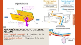 Hernia Inguinal | PPTX