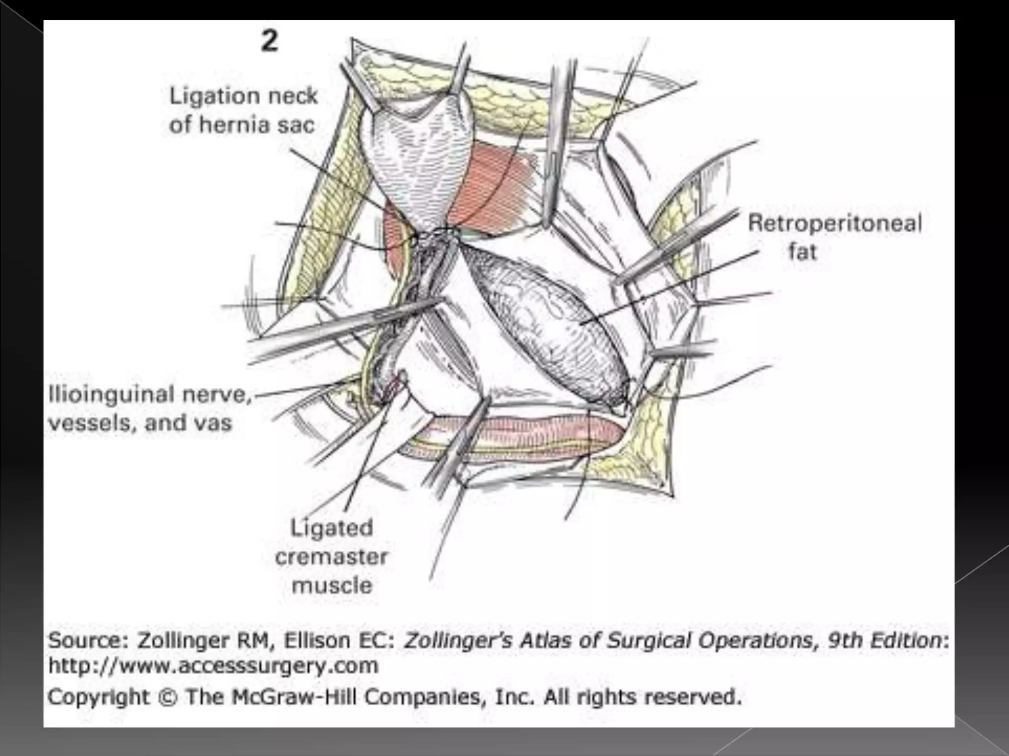 Hernia inguinal con tension | PPTX
