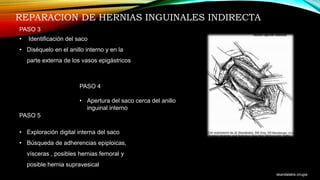 HERNIA INGUINAL Y SU ABORDAJE QUIRURGICO | PPTX