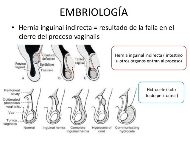 Hernia inguinal e hidrocele