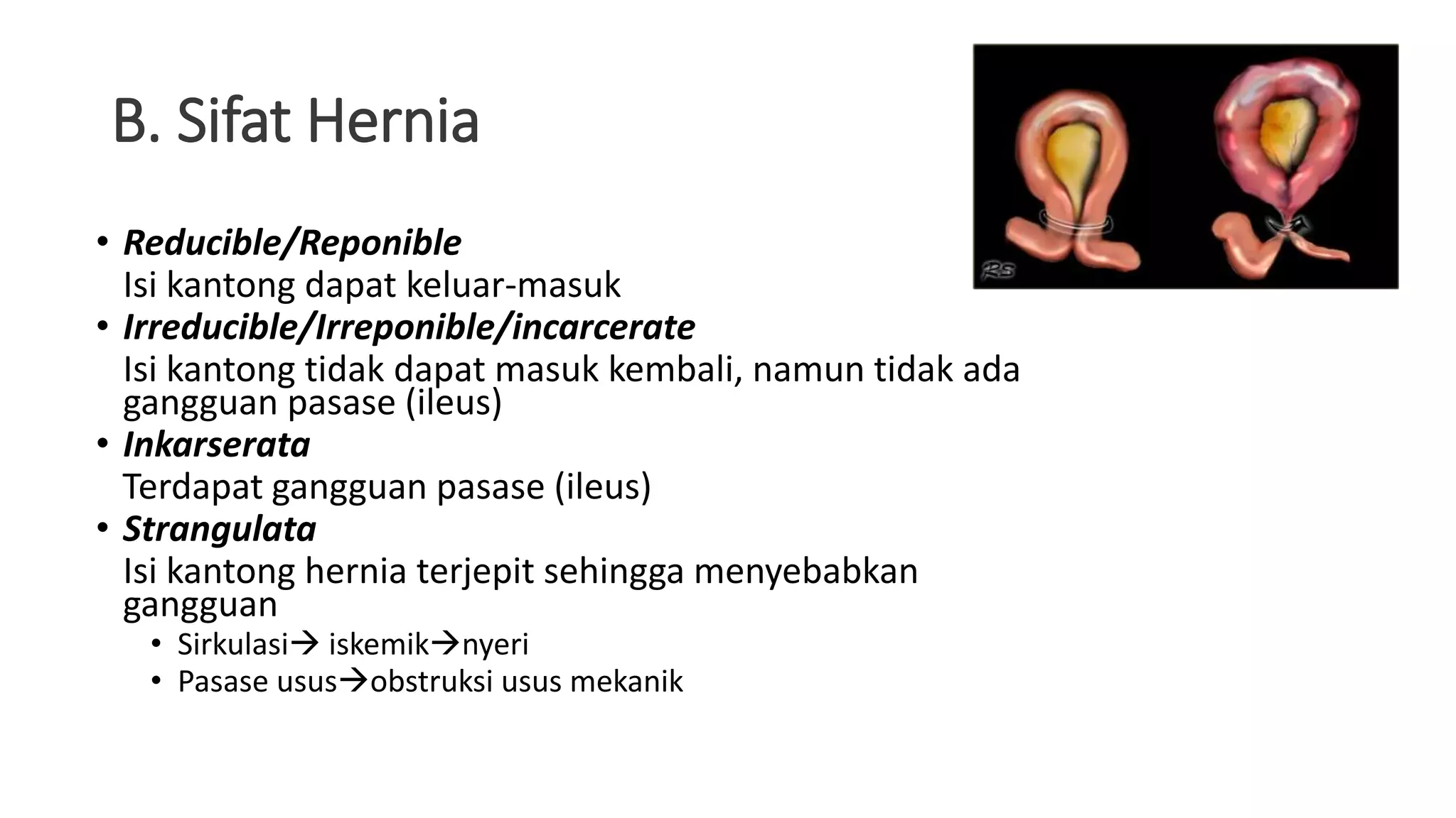 Hernia Inguinalis.pptx