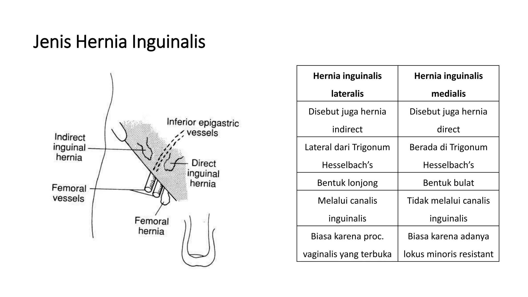 Hernia Inguinalis.pptx
