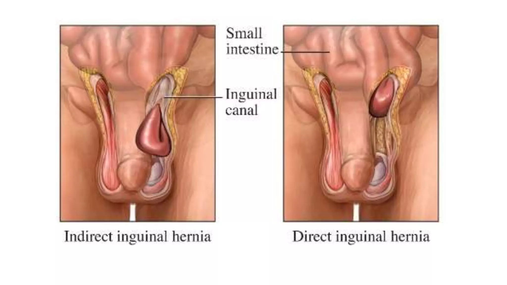 Hernia Inguinalis.pptx