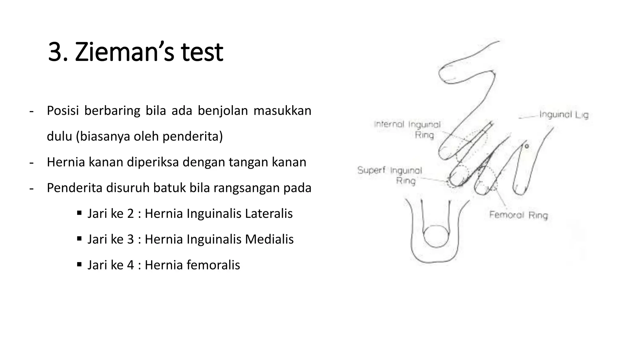 Hernia Inguinalis.pptx