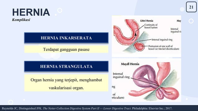 Hernia Inguinalis dan Hidrokel pada Anak | PPTX