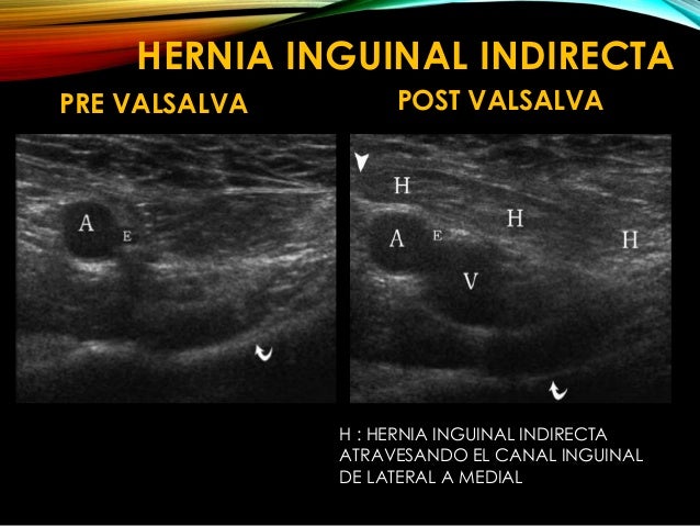 Hernia inguinal imagenologia