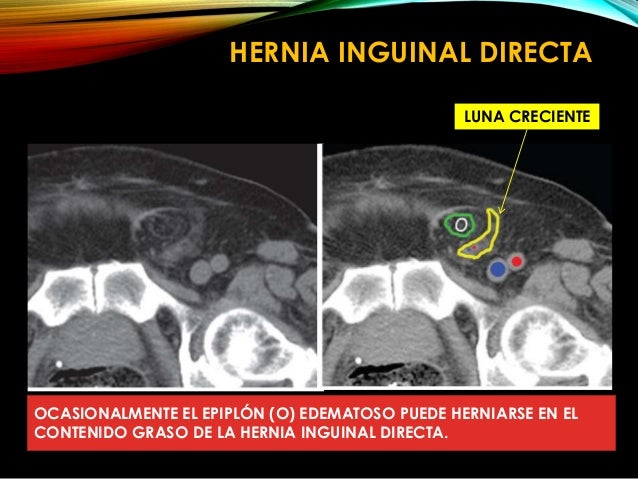 Hernia inguinal imagenologia