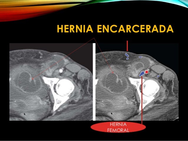 Hernia inguinal imagenologia