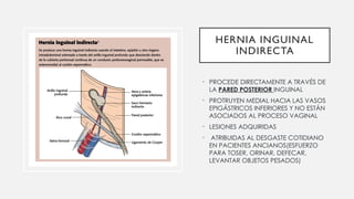 diapositivas de hernia inguinal y su fisiopatologia | PPTX