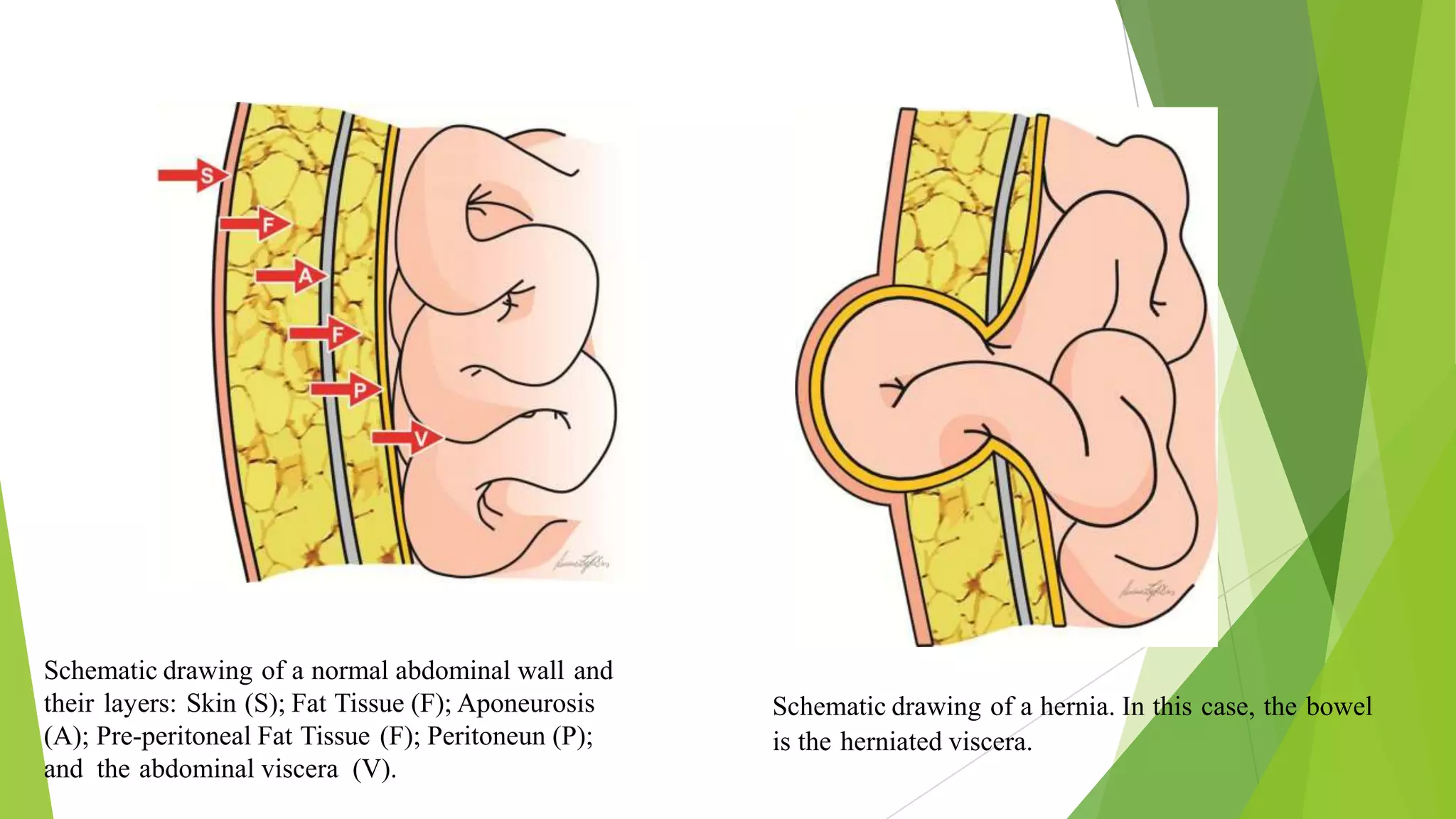 Hernial prosthesis | PPTX