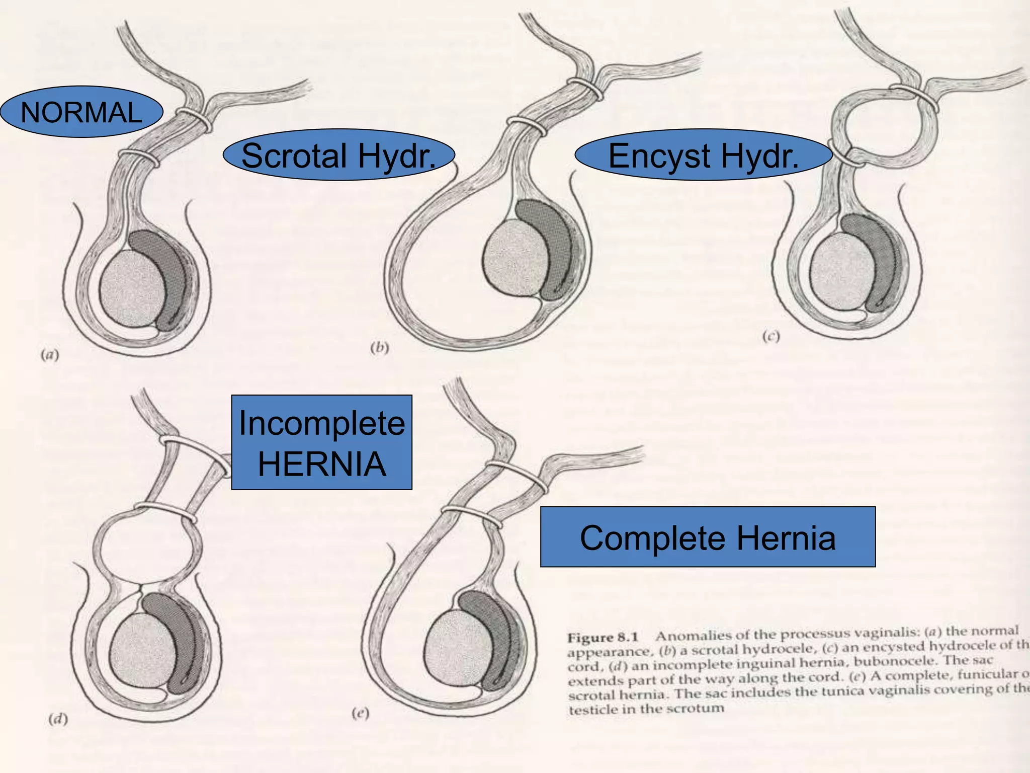 Hernia modul.ppt
