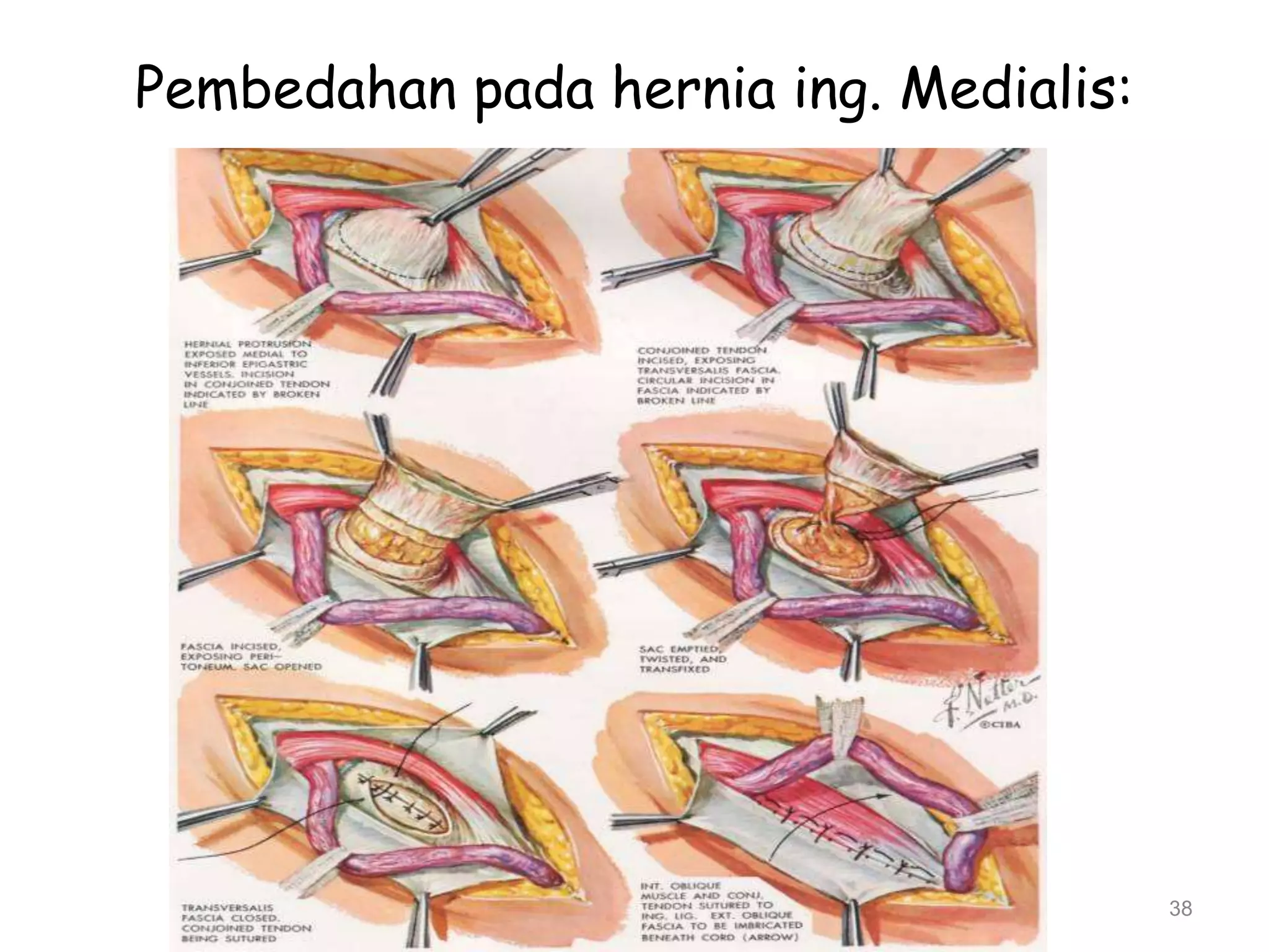 Hernia modul.ppt
