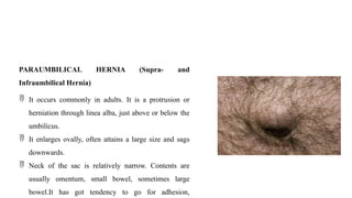 COMMON HERNIA- UMBILICAL HERNIA ITS VARIETIES.pptx