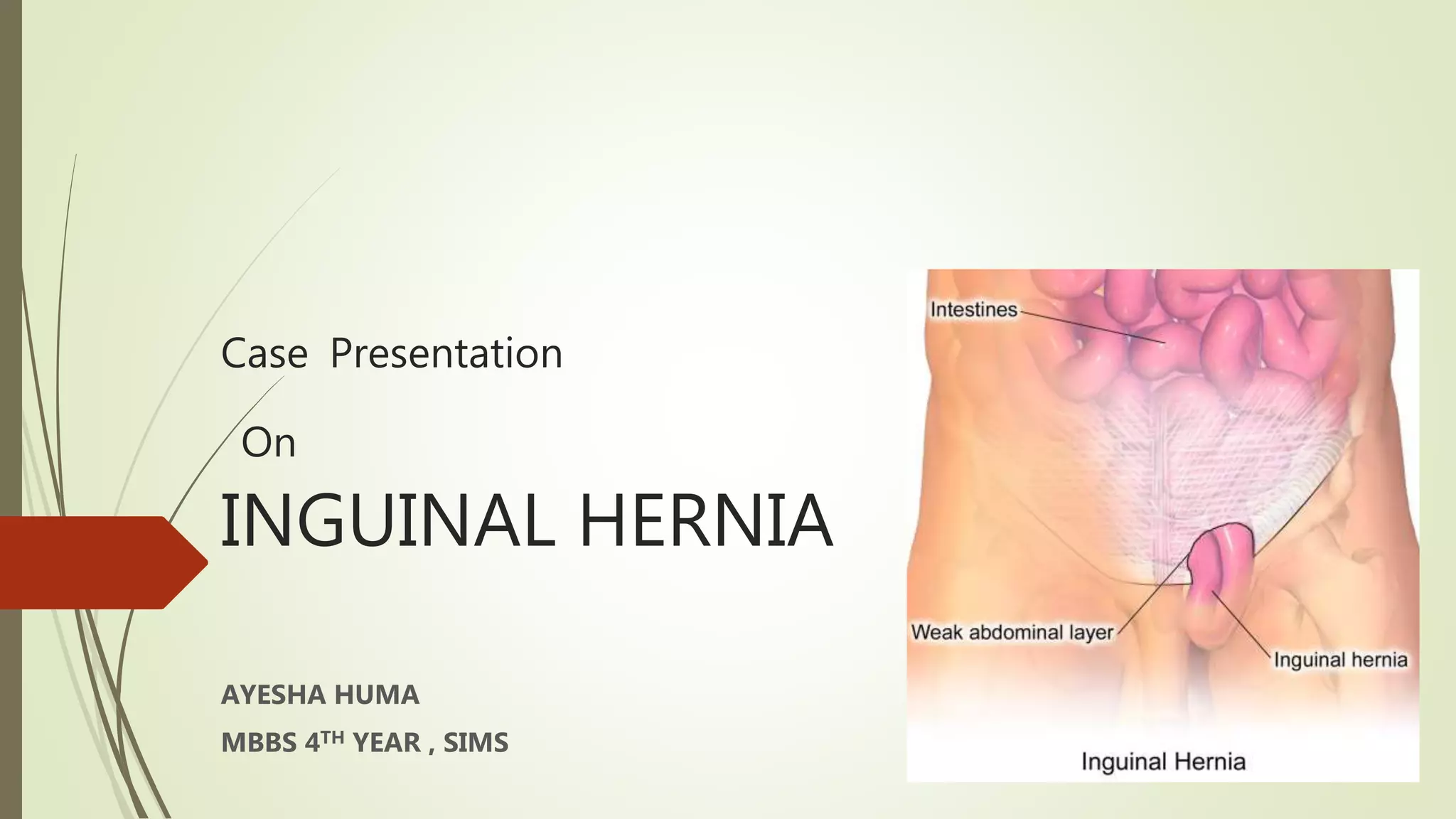HERNIA PDF.pdf