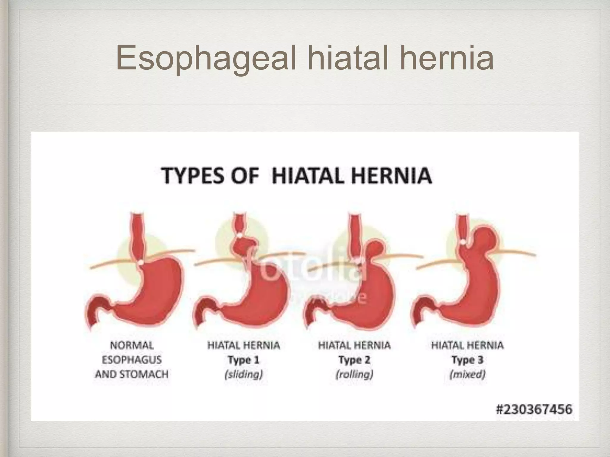 Hernia | PPTX