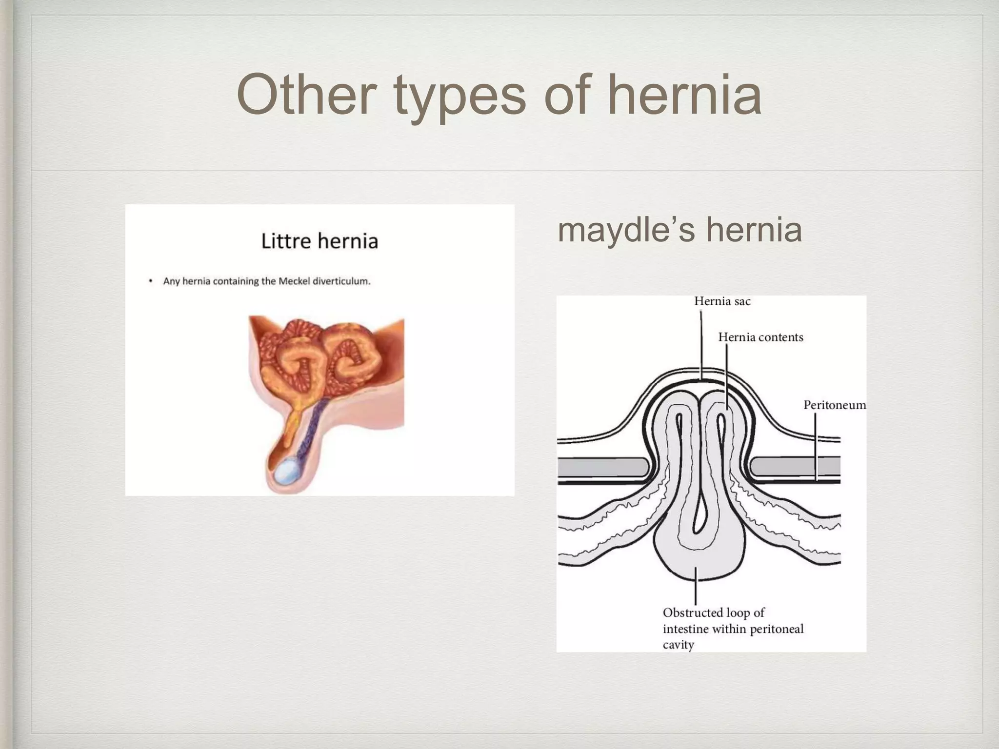 Hernia | PPTX