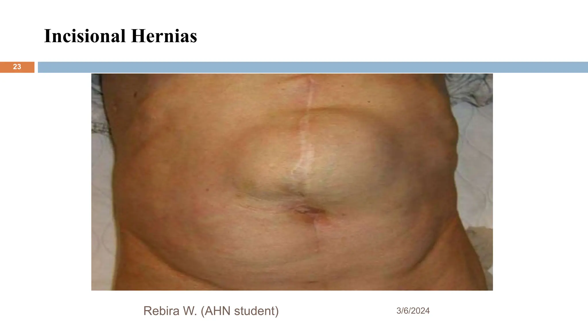 Hernia Presentation by Master Rebira W.pptx