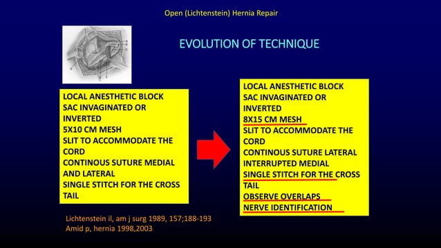 Hernia Repair (Lichtenstein) Kuliah.pptx