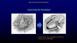 Hernia Repair (Lichtenstein) Kuliah.pptx