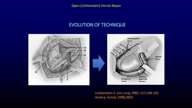 Hernia Repair (Lichtenstein) Kuliah.pptx