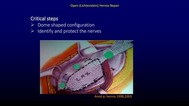 Hernia Repair (Lichtenstein) Kuliah.pptx
