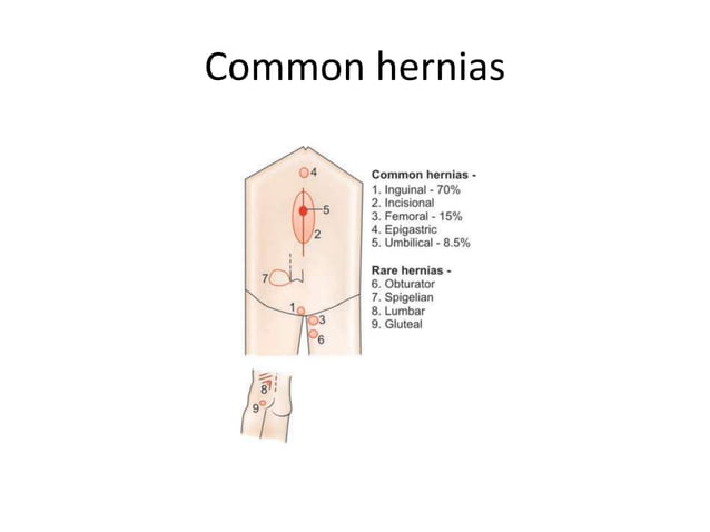 HERNIAS-1.pptx