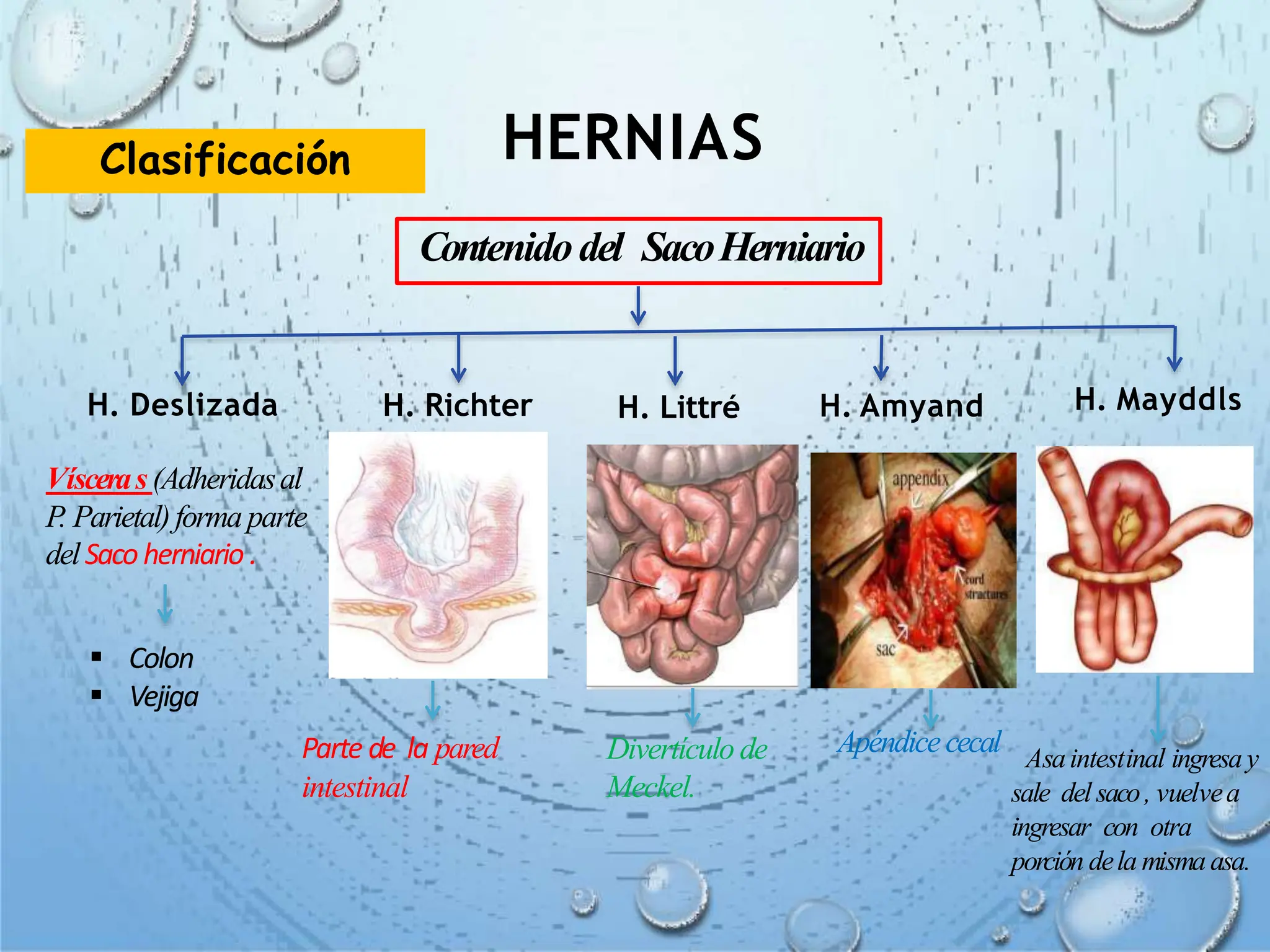 Tipos de hernias quirúrgicas y sus tratamientos | PPT
