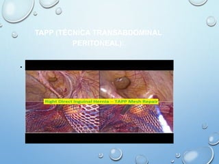 Hernias | PPTX