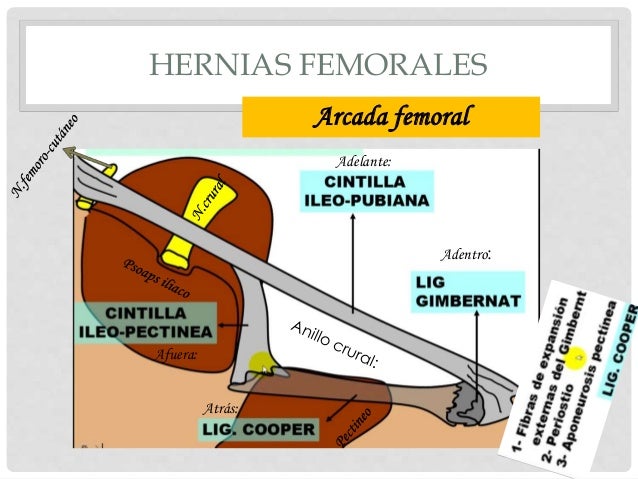 Hernias abdominales, hernia femoral hernia inguinal