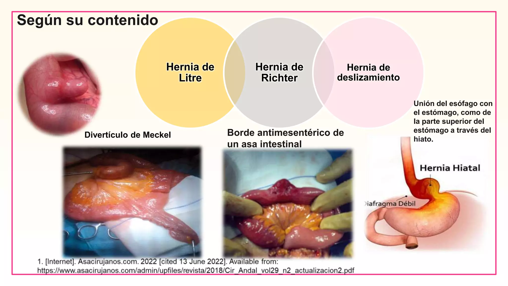 hernias.pptx