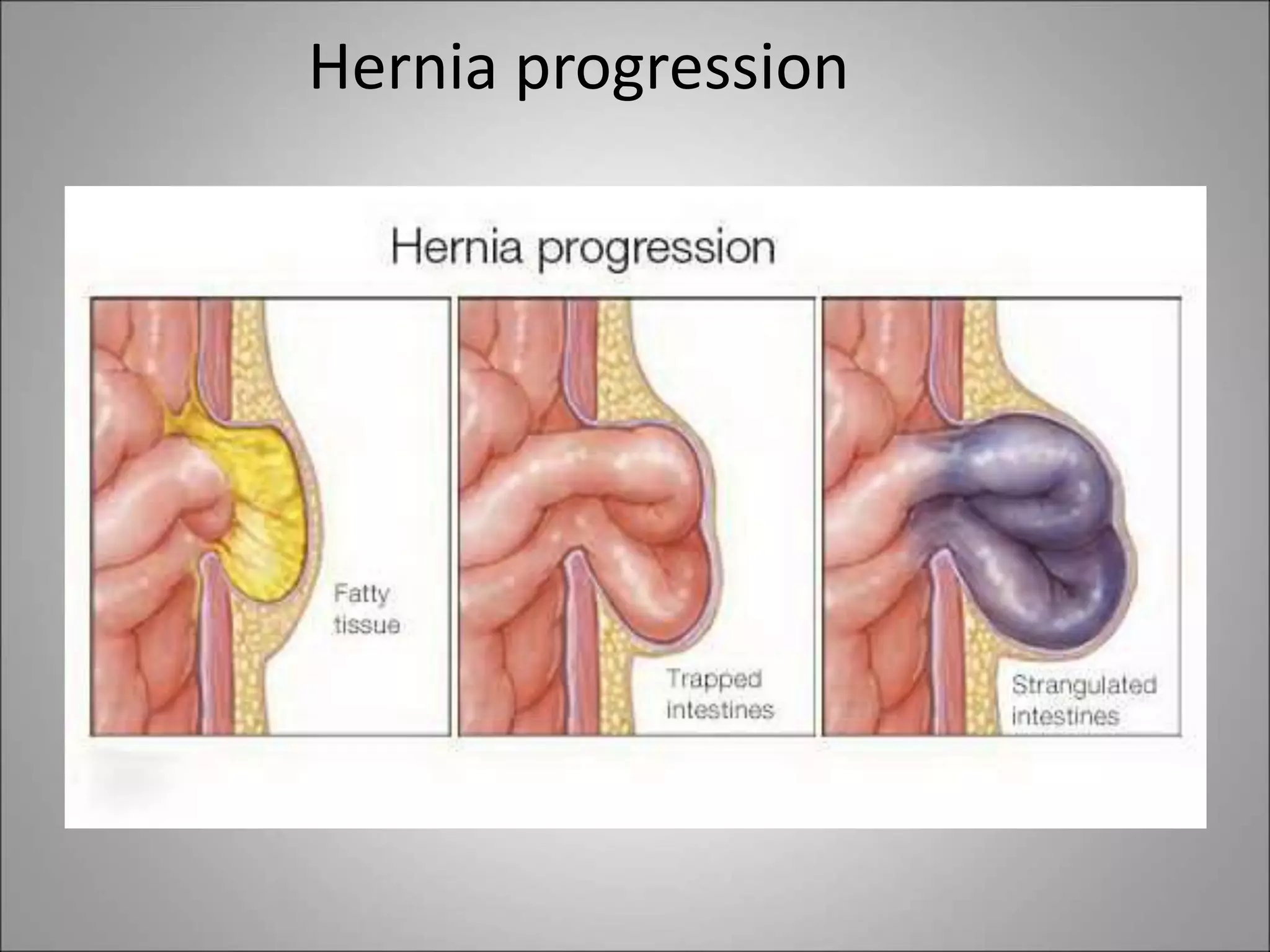Hernias.ppt