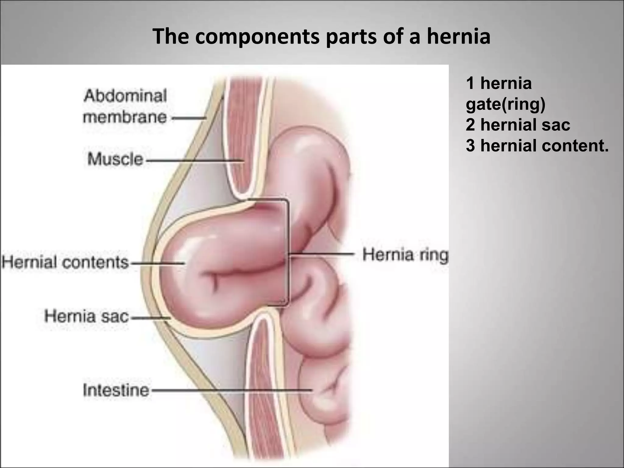 Hernias.ppt