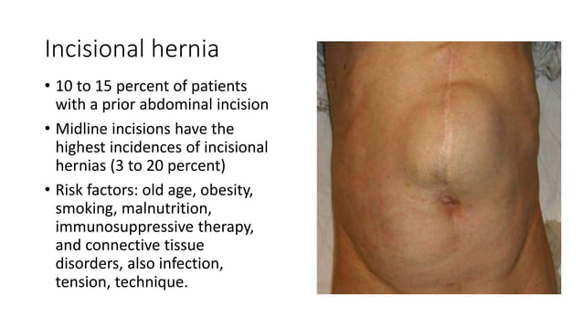 Hernias.pptx