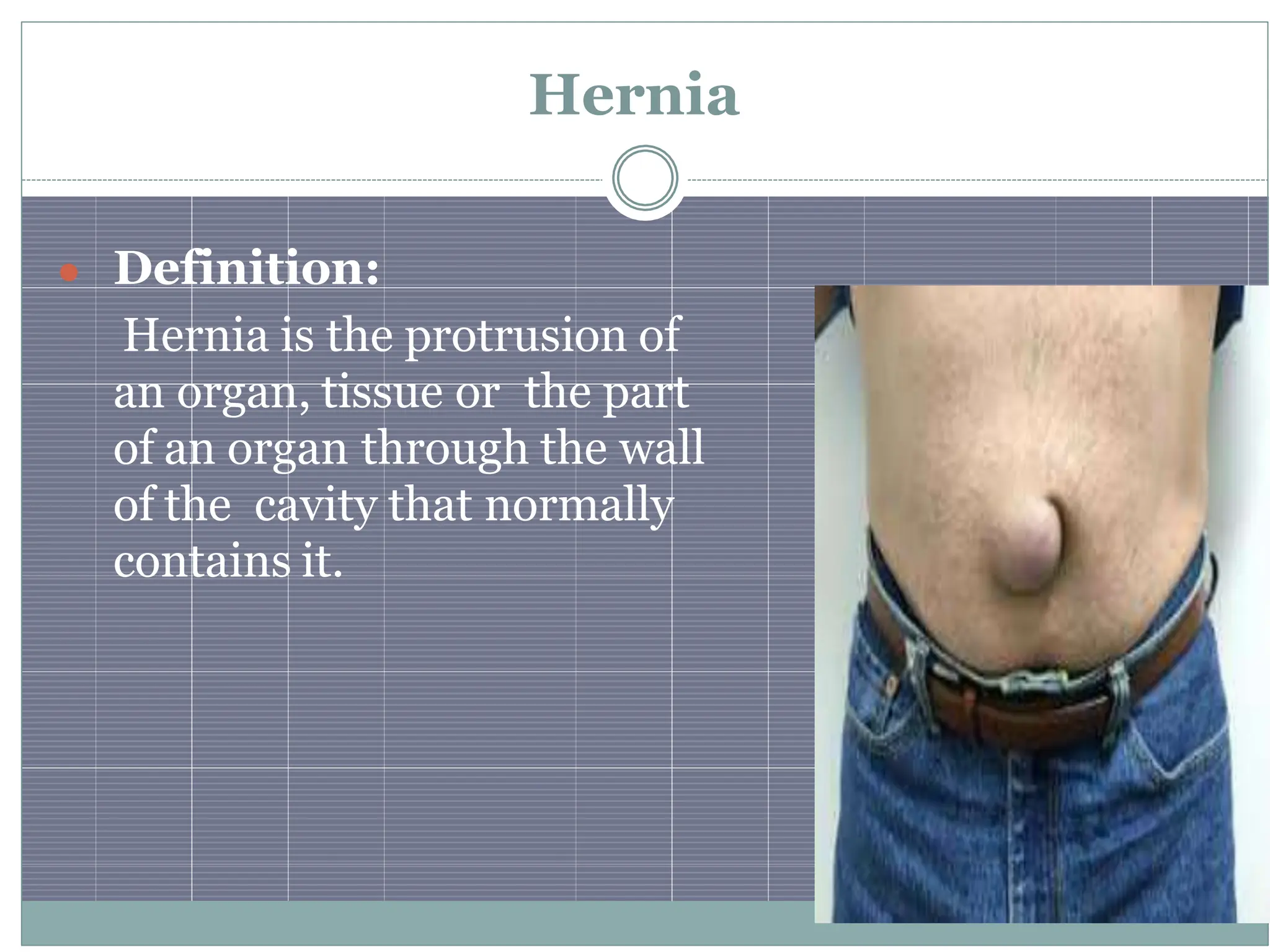 HERNIAS and its type and sign symptome treatment | PPTX