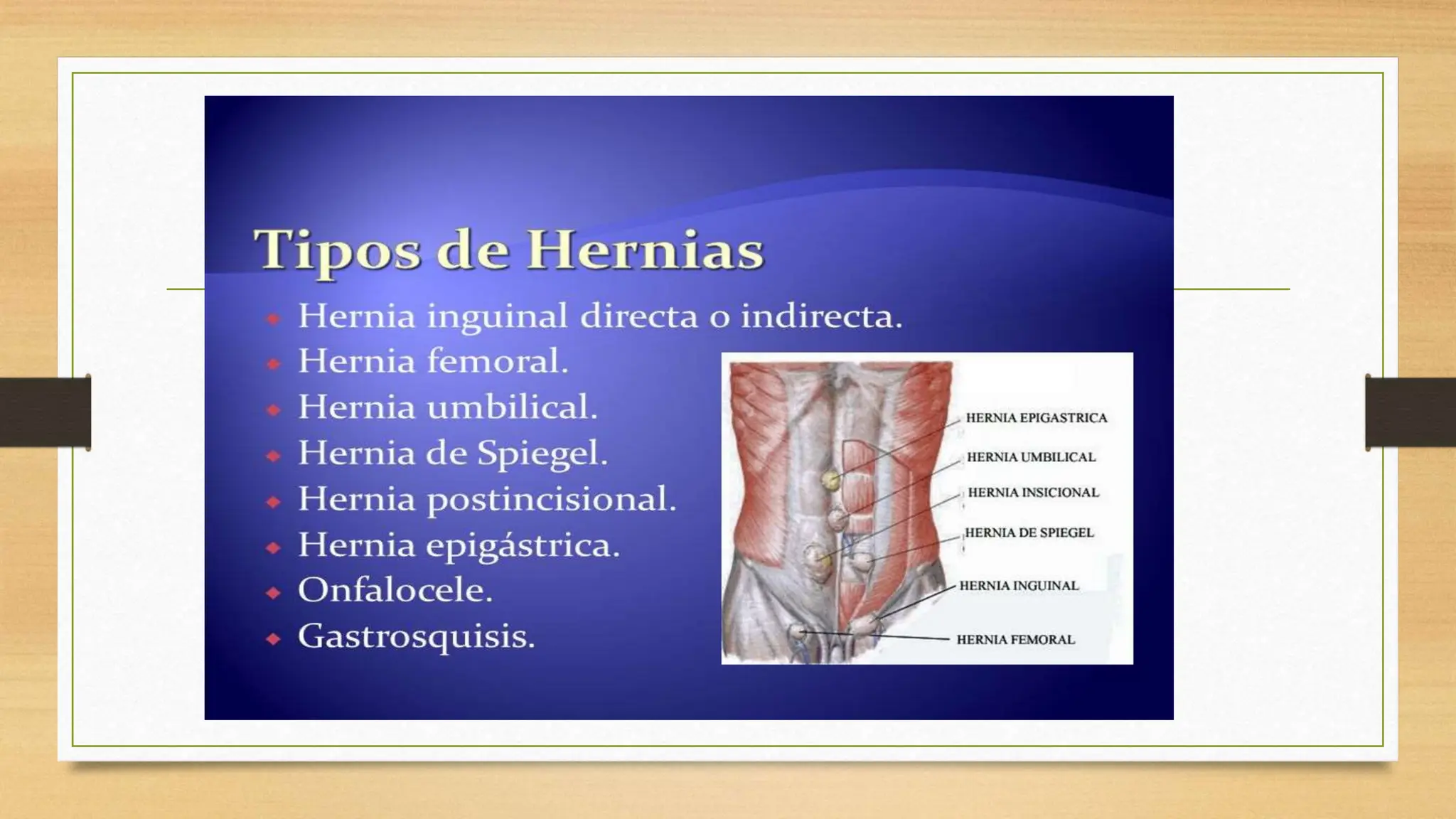 HERNIAS inguinales diagnóstico etiología y tratamiento | PPTX