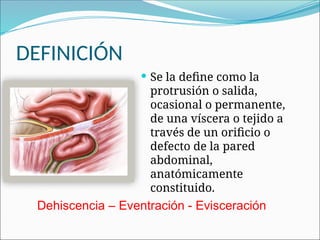 Hernias de la pared abdominal y anatomia | PPTX