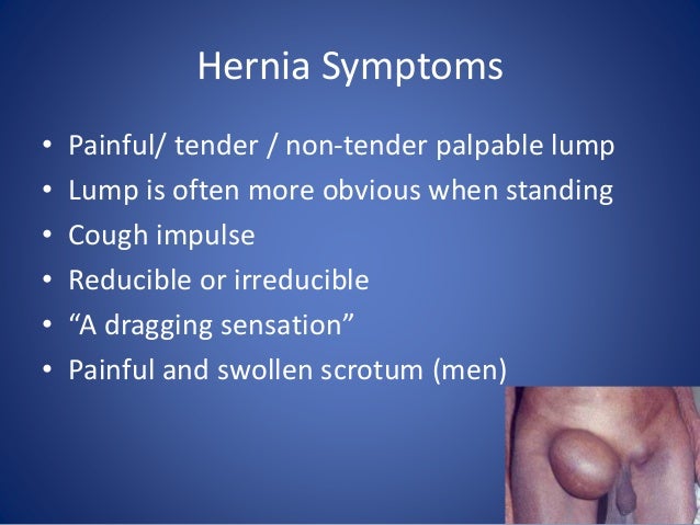 Femoral Hernia Symptoms Men Hernias And Groin Swellings Most Femoral Hernias Cause No Symptoms